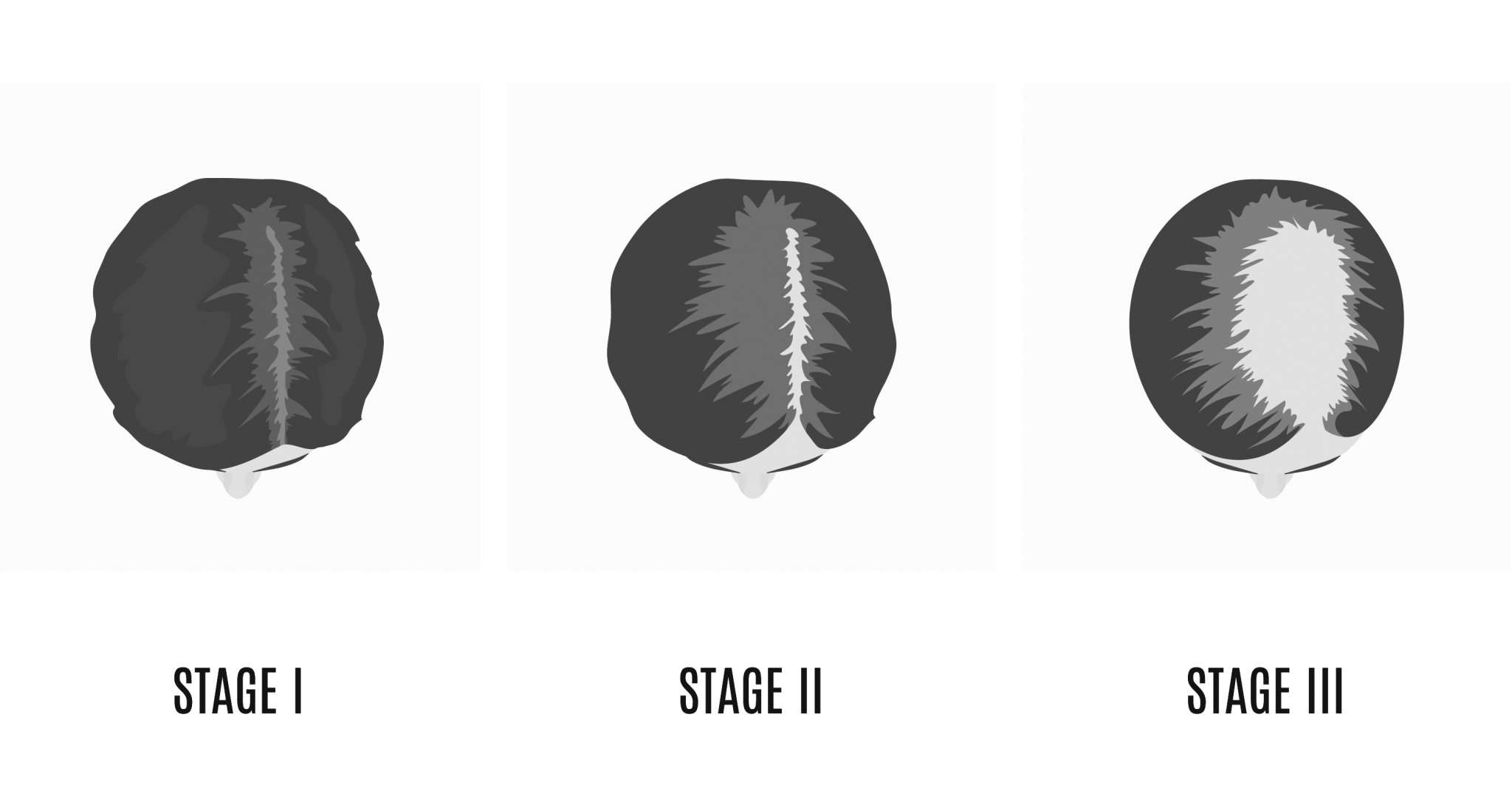 Hair Loss Evaluation and Treatment | Miami Hair Institute