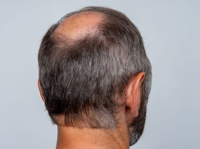 Hair Miniaturization & How to Treat It - Miami Hair Institute