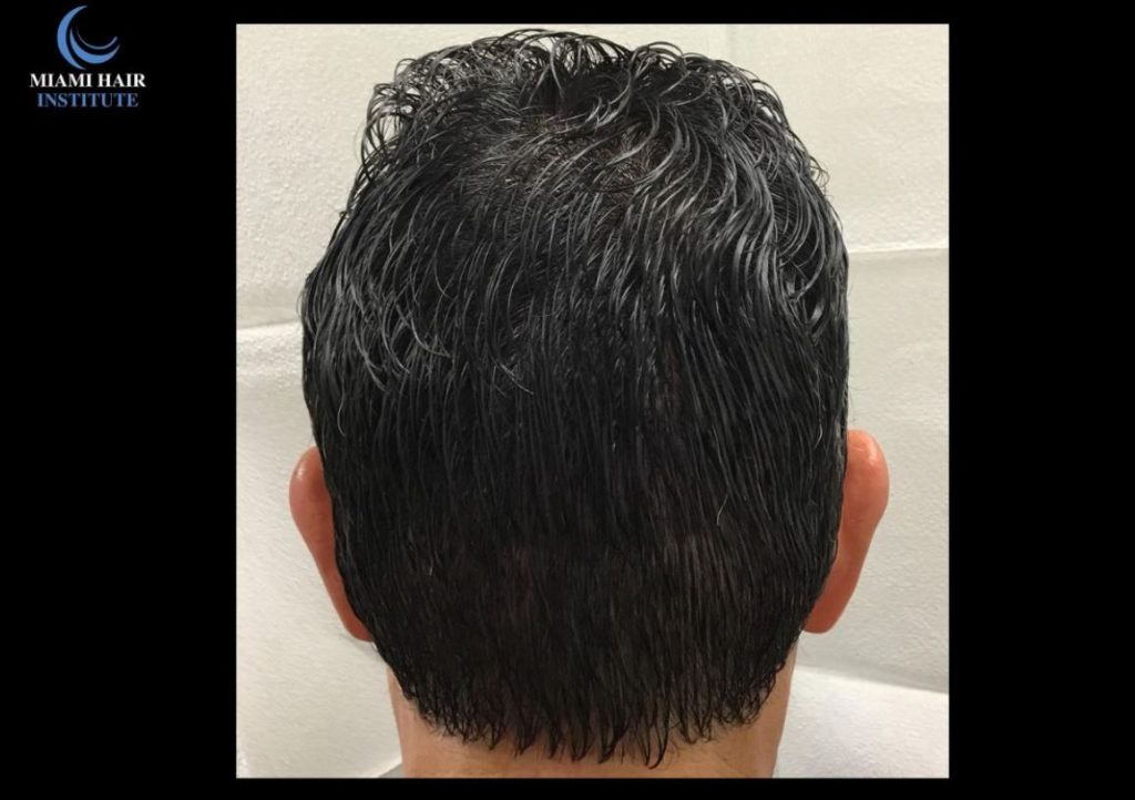 Do You Have to Shave Your Head for a Hair Transplant? | Miami Hair